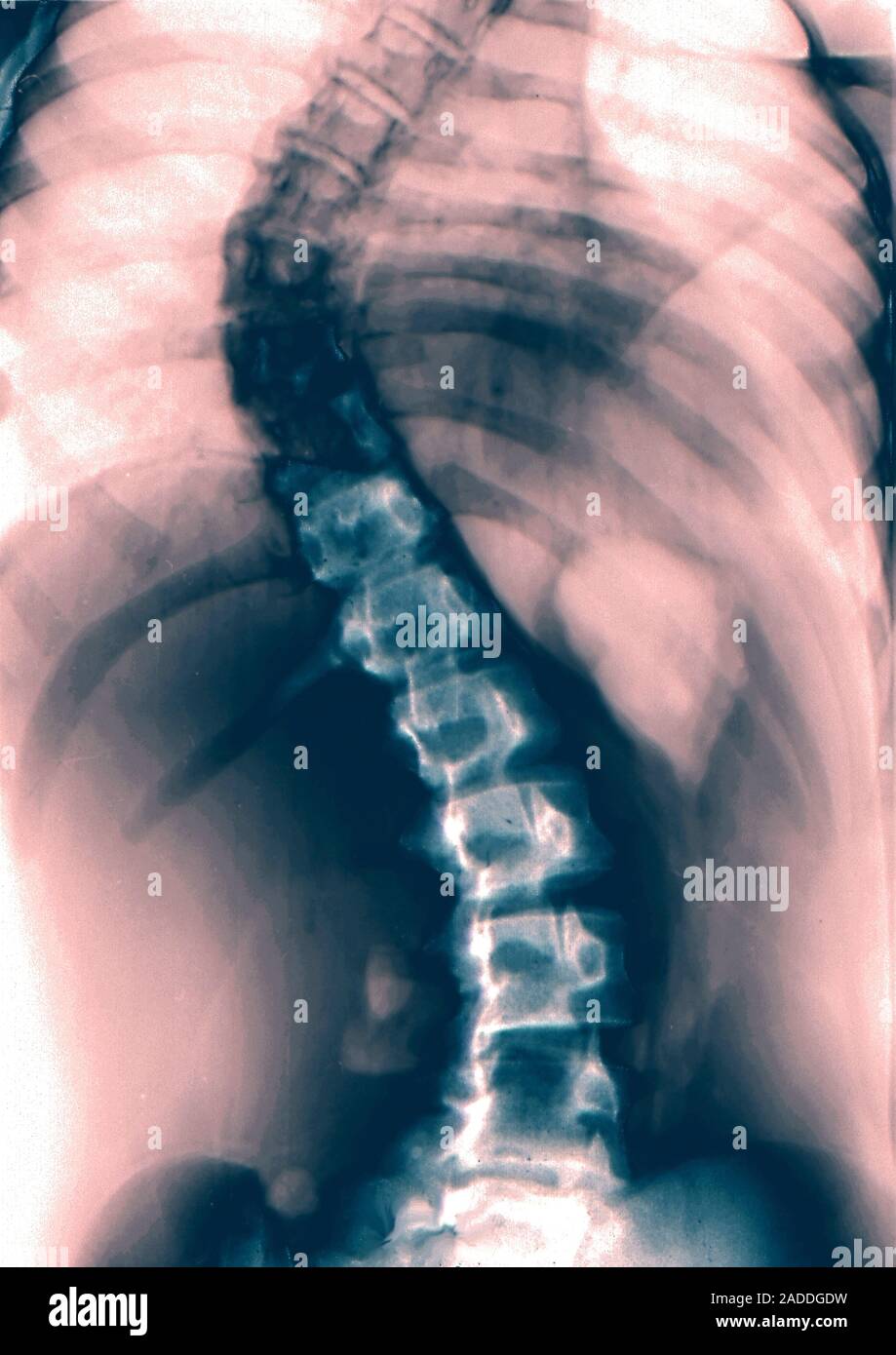 Scoliosis. Coloured X-ray of the backbone of a 22-year-old woman with ...