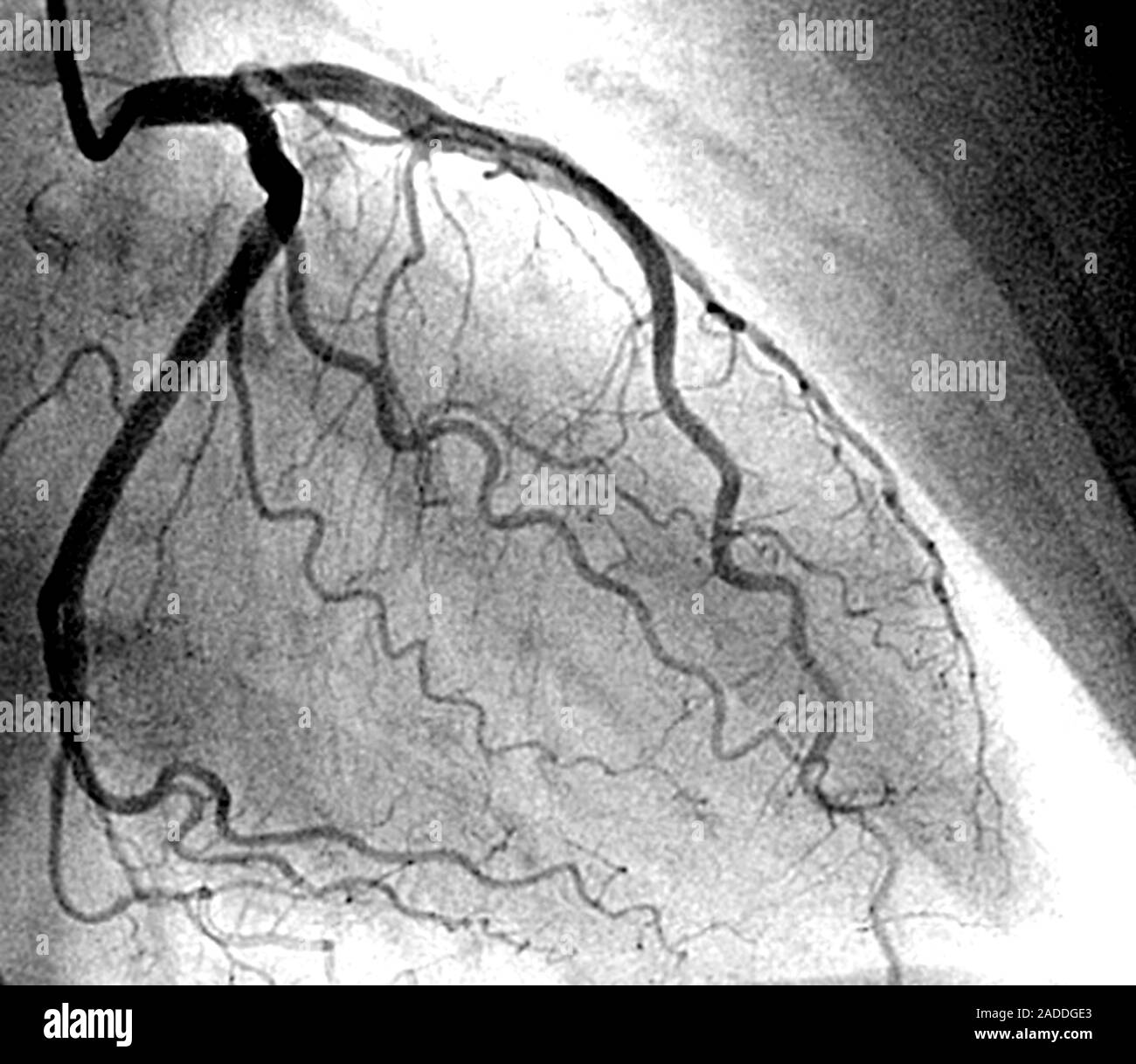 Left coronary artery. Coronarography (contrast medium X-ray) scan of ...