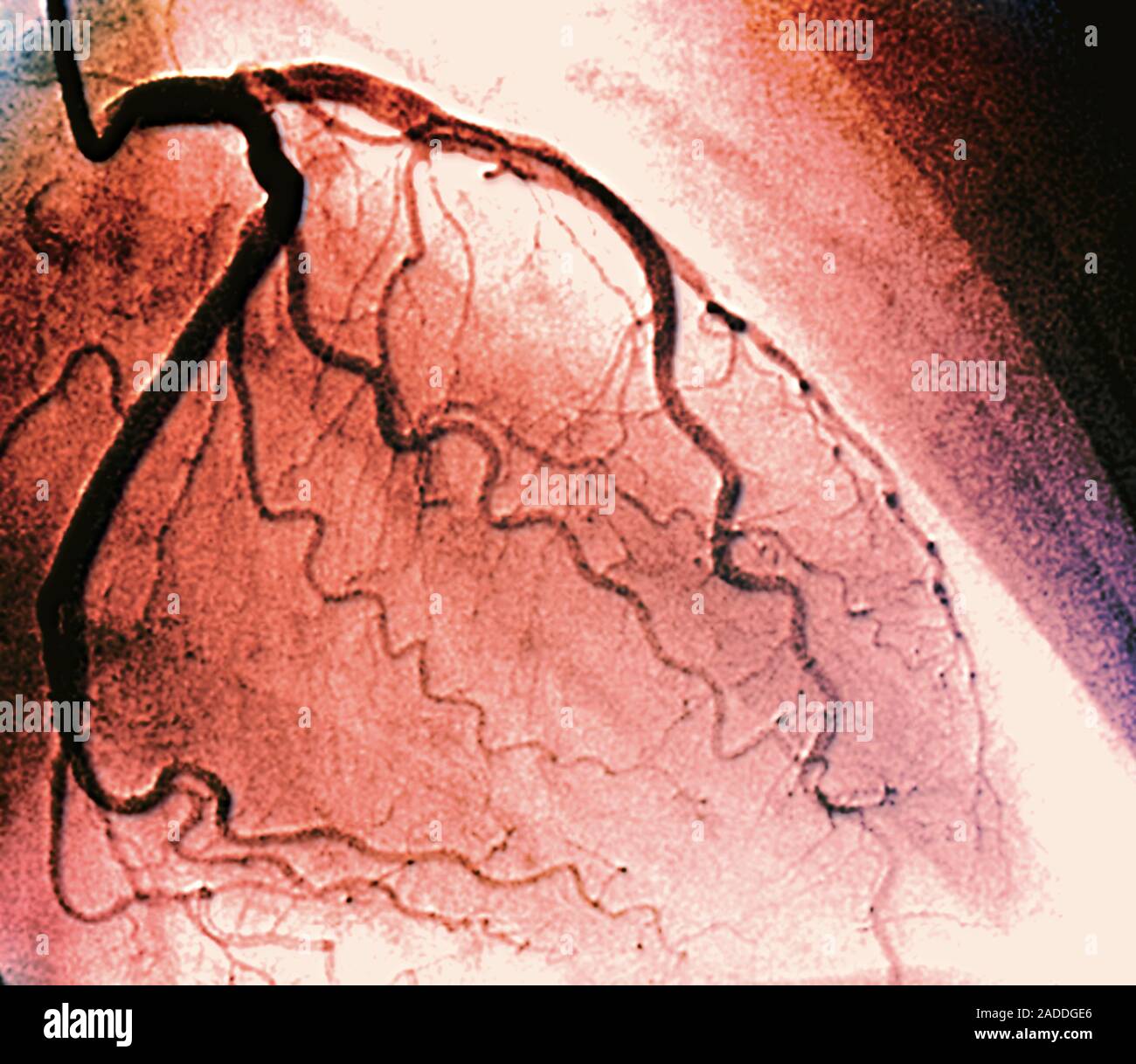 Left coronary artery. Coloured coronarography (contrast medium X-ray ...