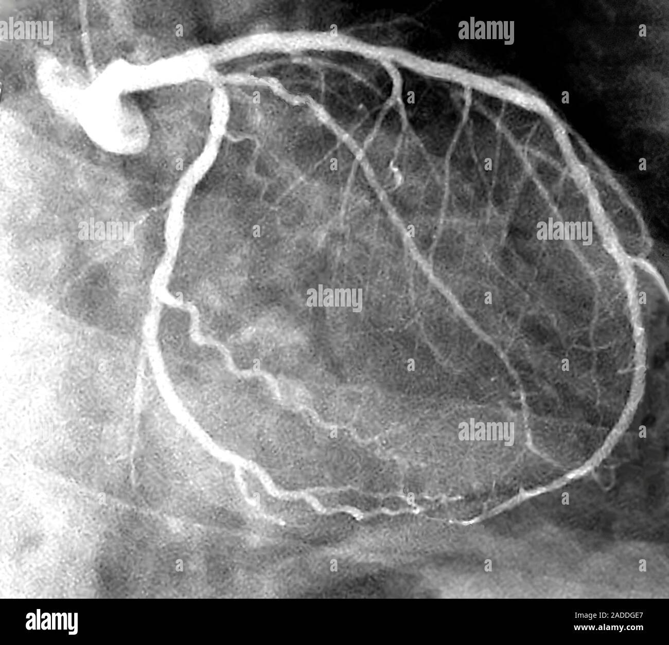 Left coronary artery. Coronarography (contrast medium X-ray) scan of ...
