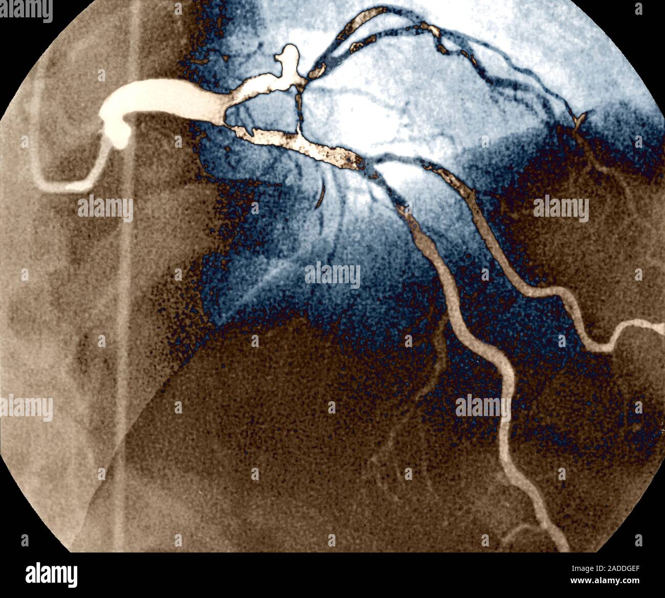Coronary artery stenosis. Coloured coronarography (contrast medium X ...