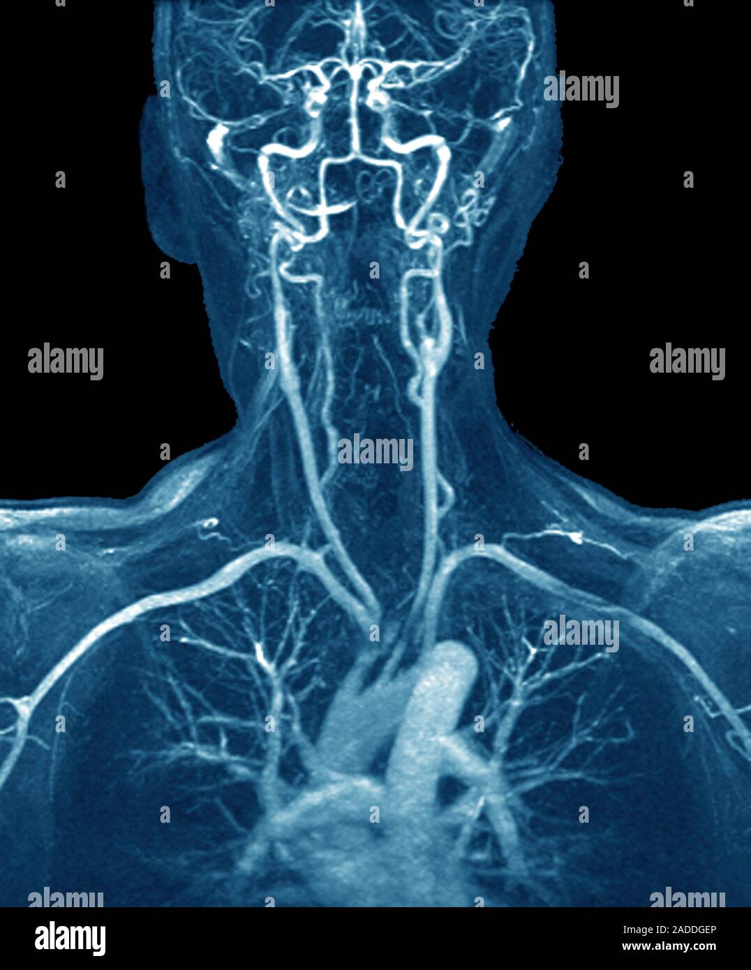 Chest, neck and head arteries. Coloured frontal magnetic resonance ...