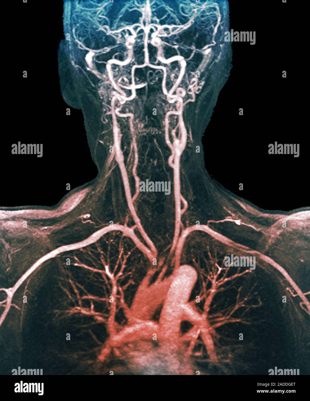Chest, neck and head arteries. Coloured frontal magnetic resonance ...