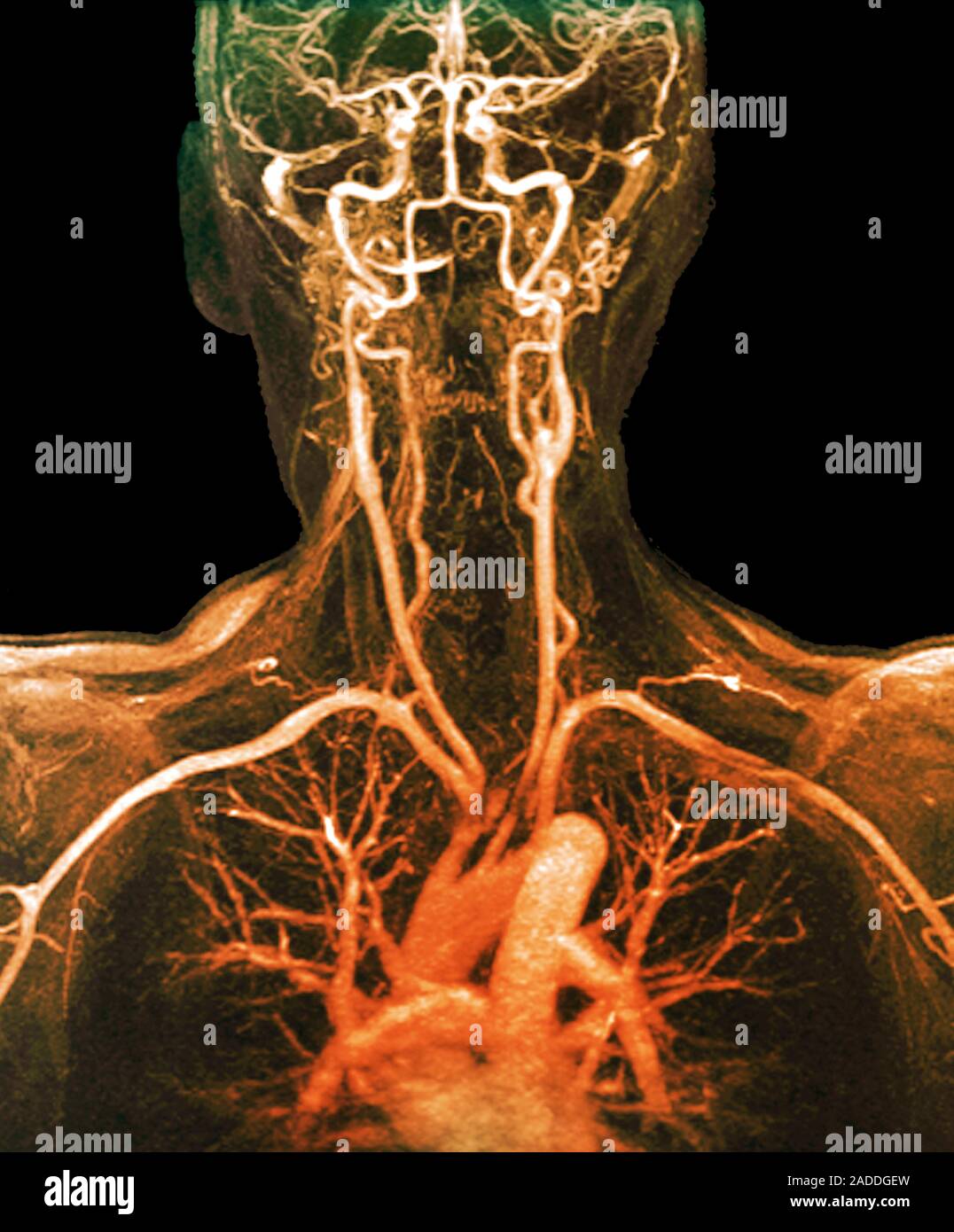 Chest, neck and head arteries. Coloured frontal magnetic resonance ...