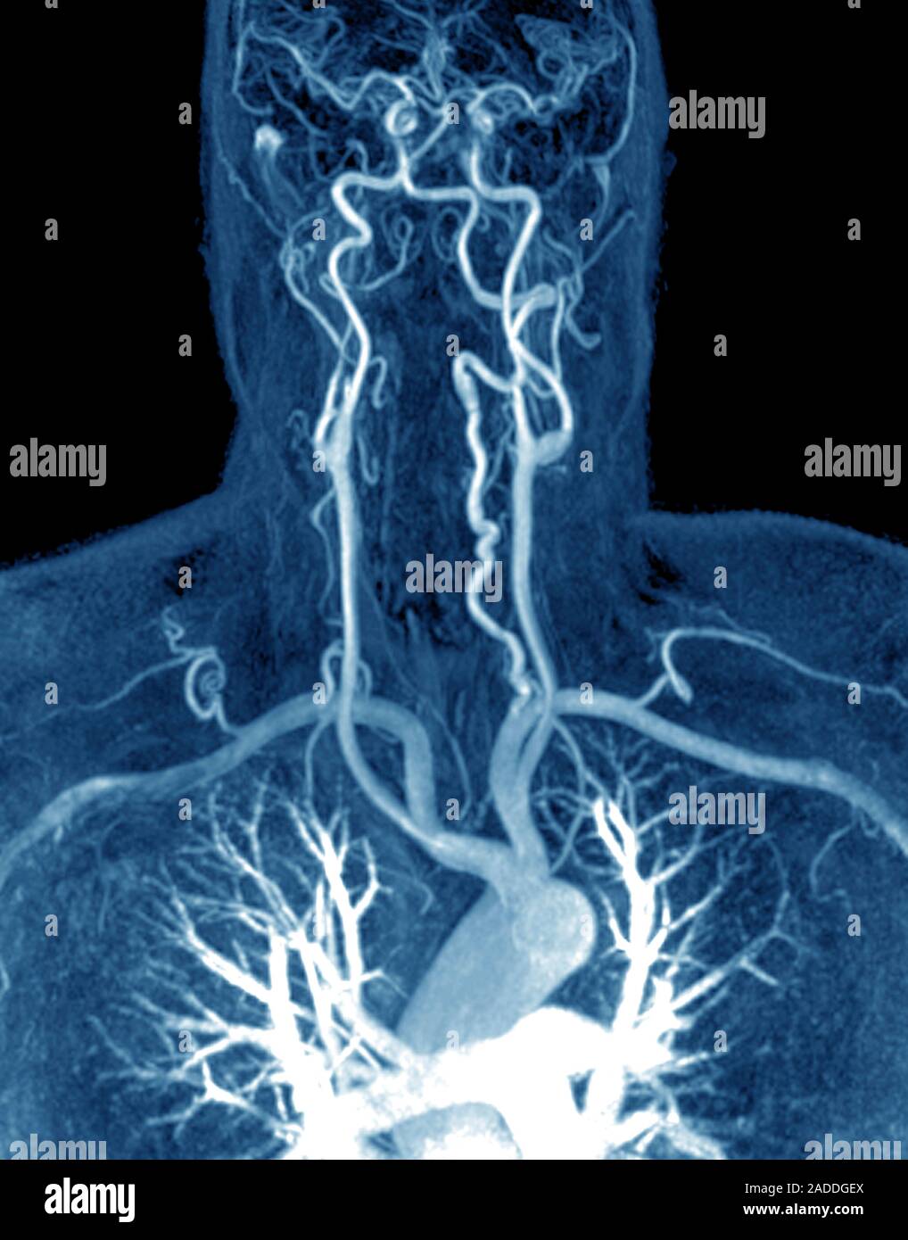 Cervical artery dissection. Coloured frontal magnetic resonance ...