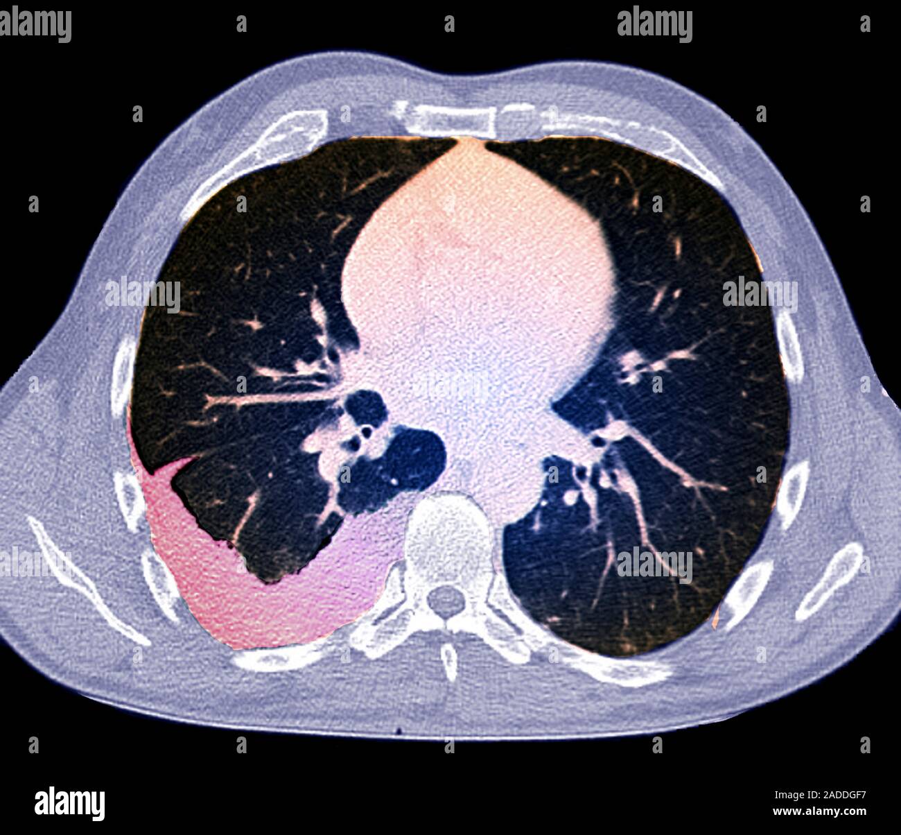 Internal bleeding in pleural cavity. Coloured axial computed tomography ...