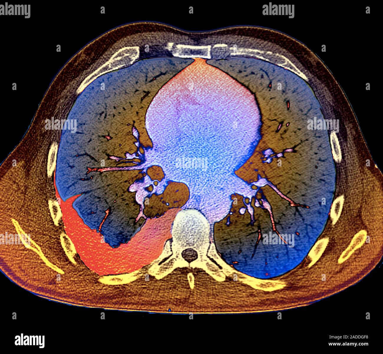Internal bleeding in pleural cavity. Coloured axial computed tomography ...
