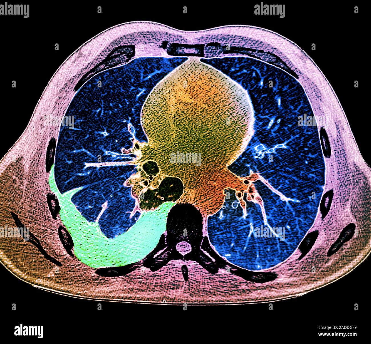 Internal bleeding in pleural cavity. Coloured axial computed tomography ...