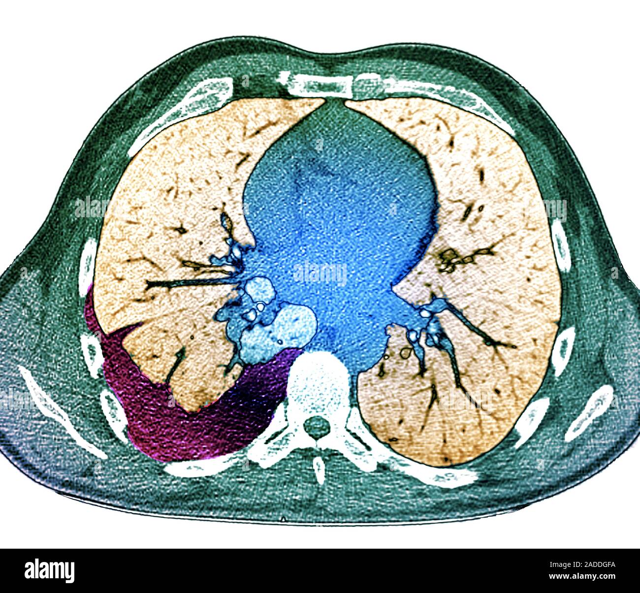 Internal bleeding in pleural cavity. Coloured axial computed tomography ...