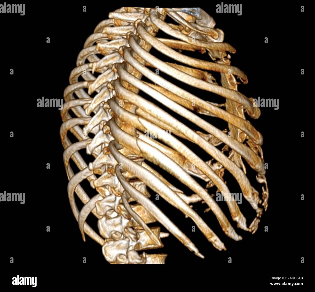 Rib fractures. Coloured 3D computed tomography (CT) scan of the ribcage ...