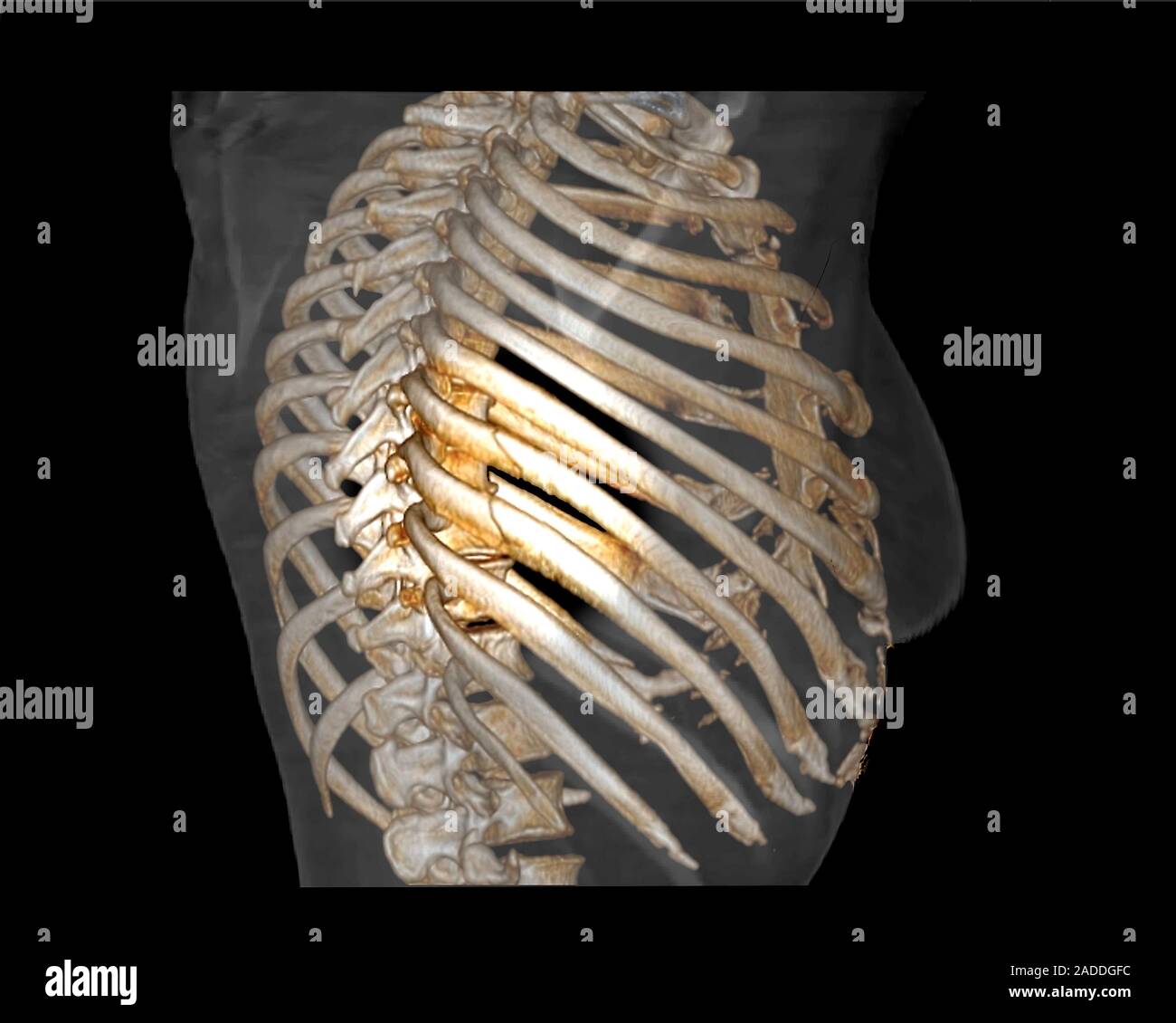 Rib fractures. Coloured 3D computed tomography (CT) scan of the ribcage ...