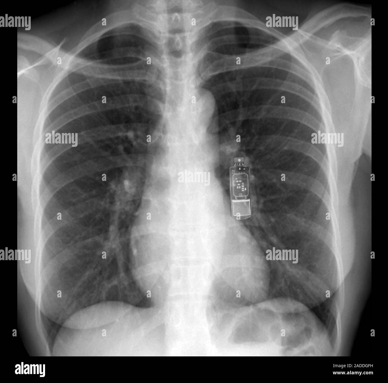 Cardiac monitoring device. Frontal X-ray of the chest of a 32-year-old ...