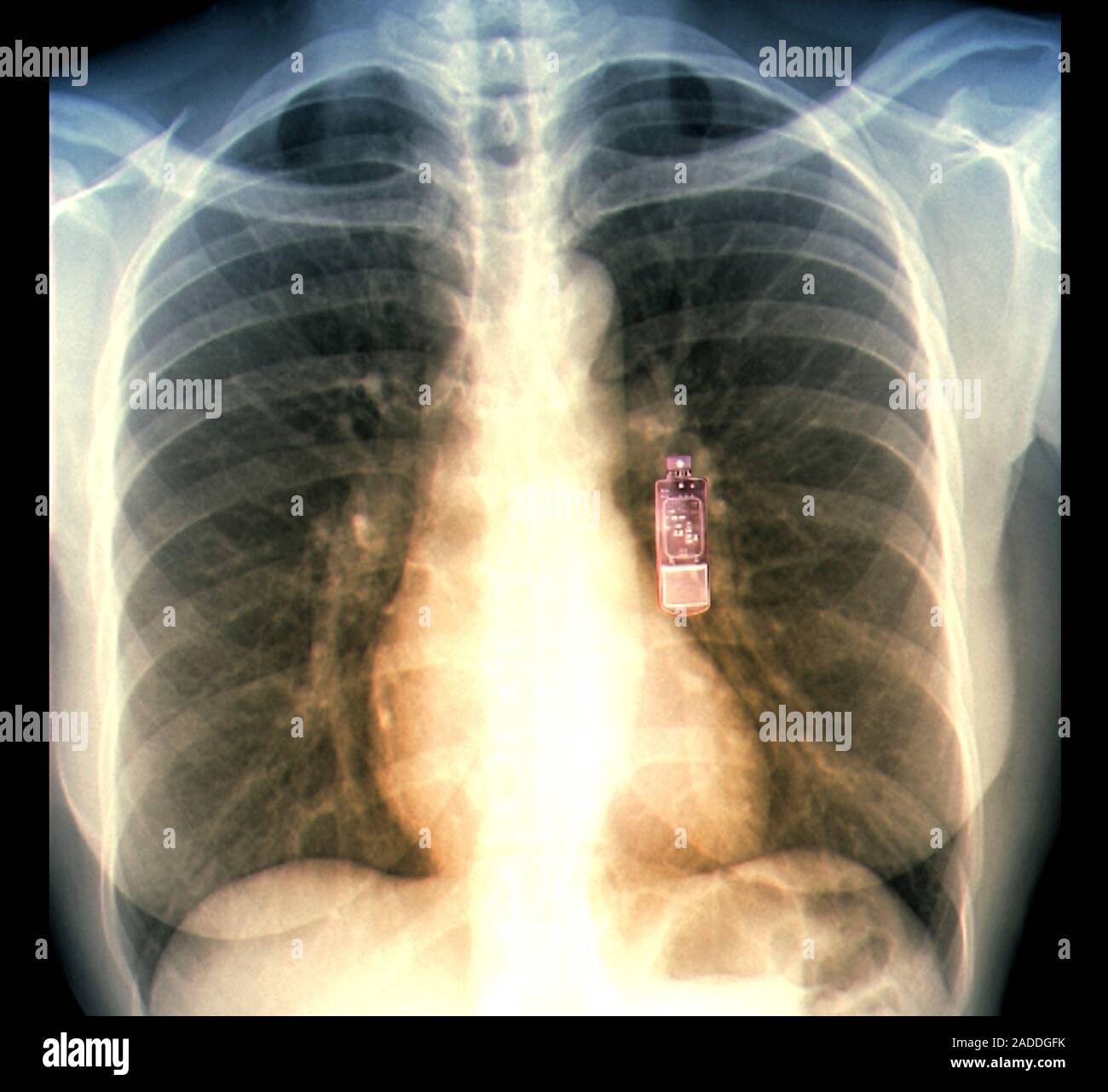 Cardiac monitoring device. Coloured frontal X-ray of the chest of a 32 ...