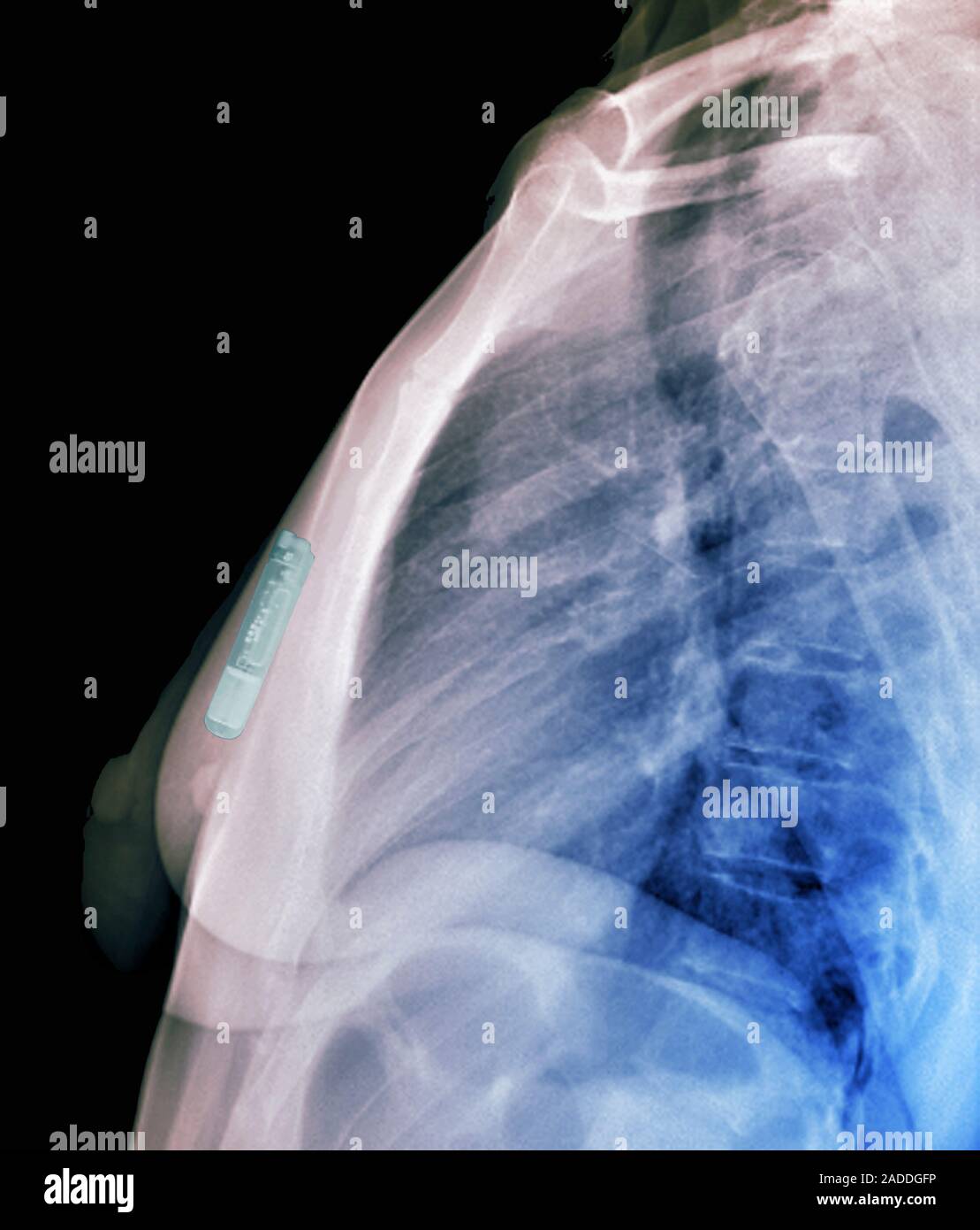 Cardiac monitoring device. Coloured lateral X-ray of the chest of a 32 ...