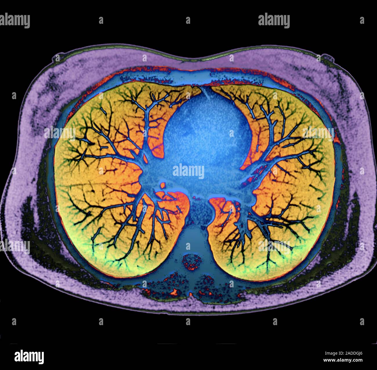 Heart and lungs. Axial computed tomography (CT) scan of the chest of a ...