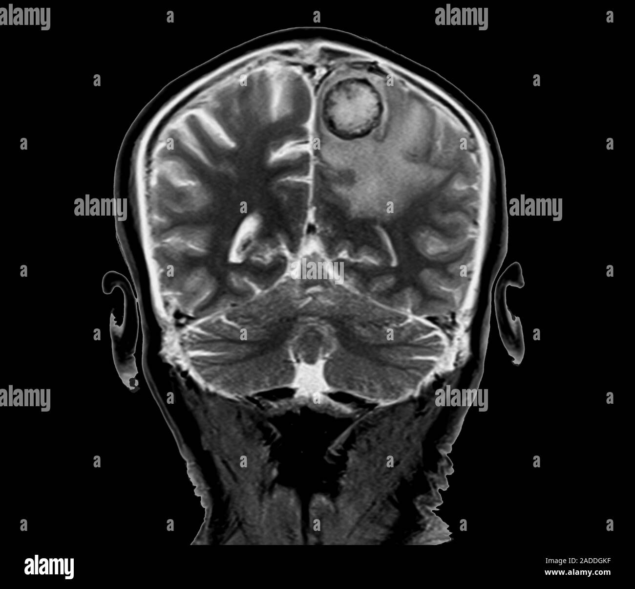 Secondary brain cancer. Coronal magnetic resonance imaging (MRI) scan through the brain of a 48 ...
