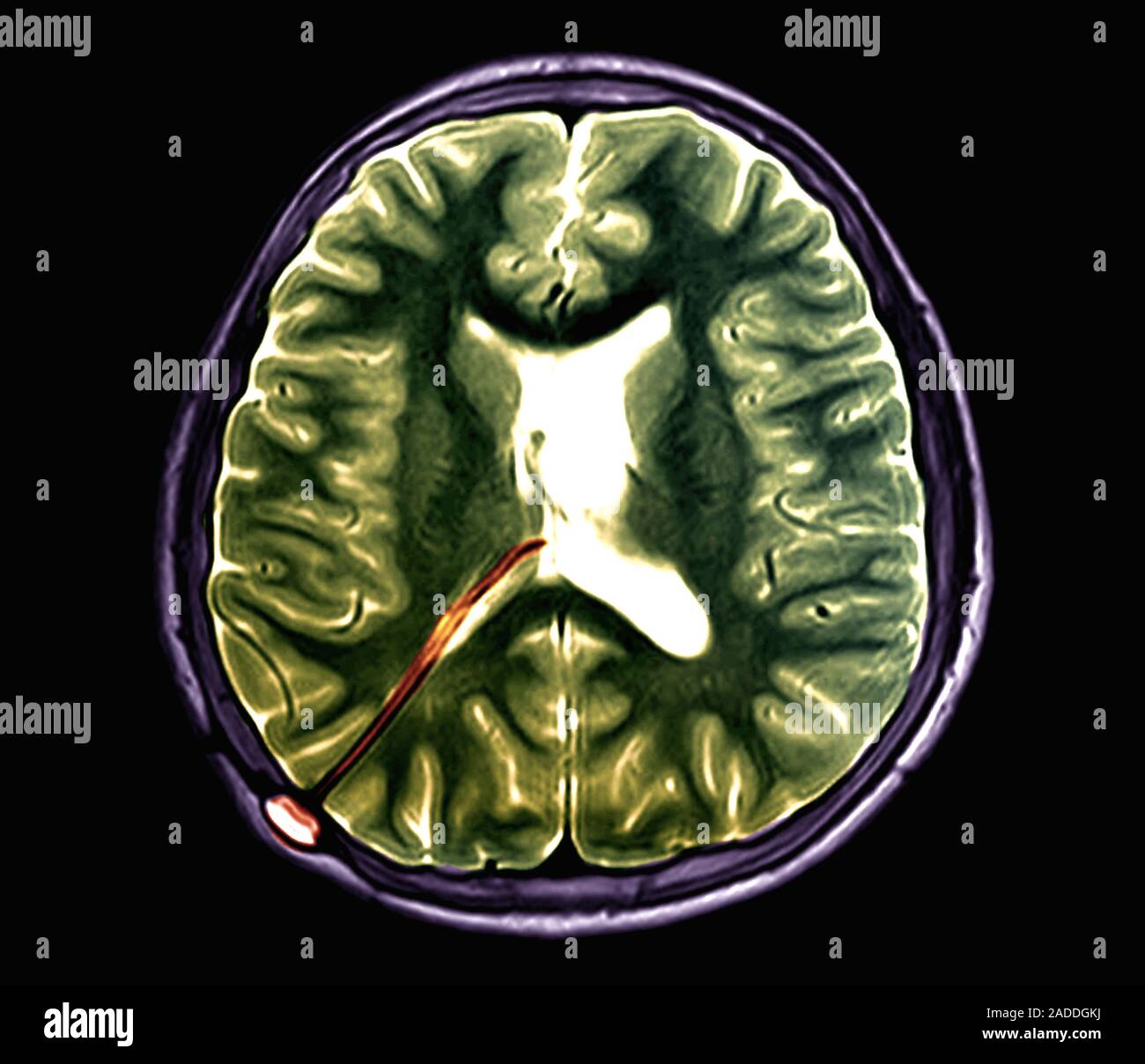 Hydrocephalus treatment. Coloured axial magnetic resonance imaging (MRI ...