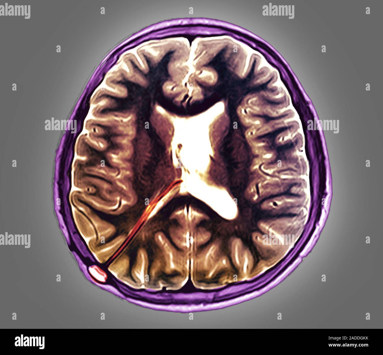 Hydrocephalus treatment. Coloured axial magnetic resonance imaging (MRI ...