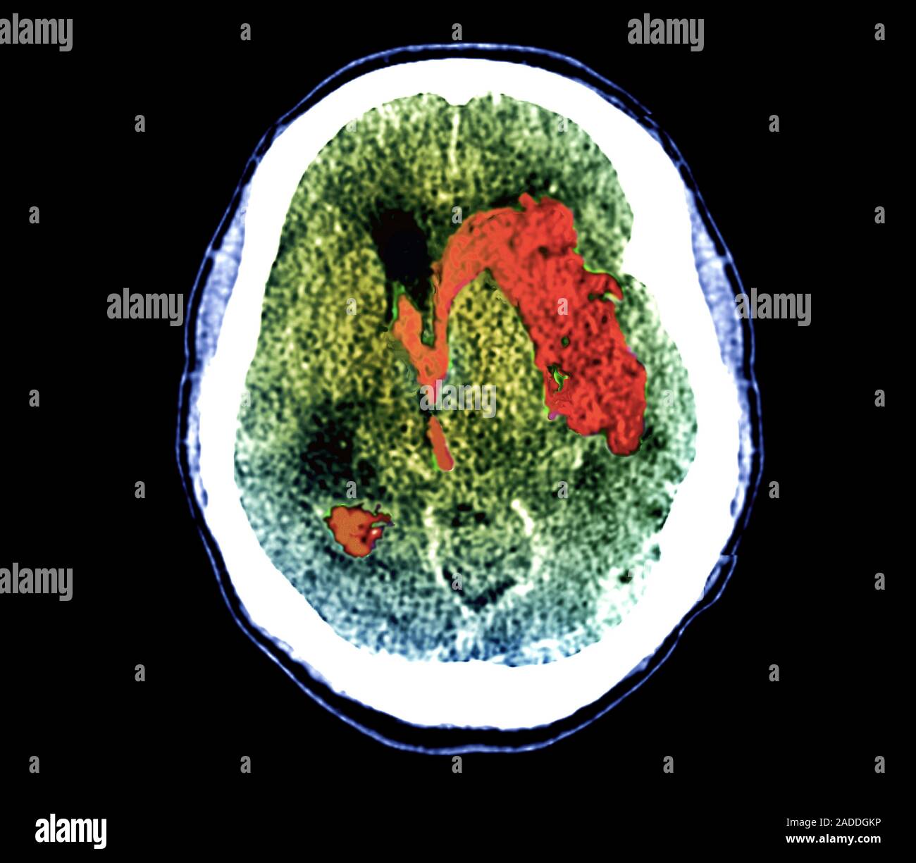 Stroke and intracerebral haemorrhage. Coloured axial computed tomography (CT) scan through the ...