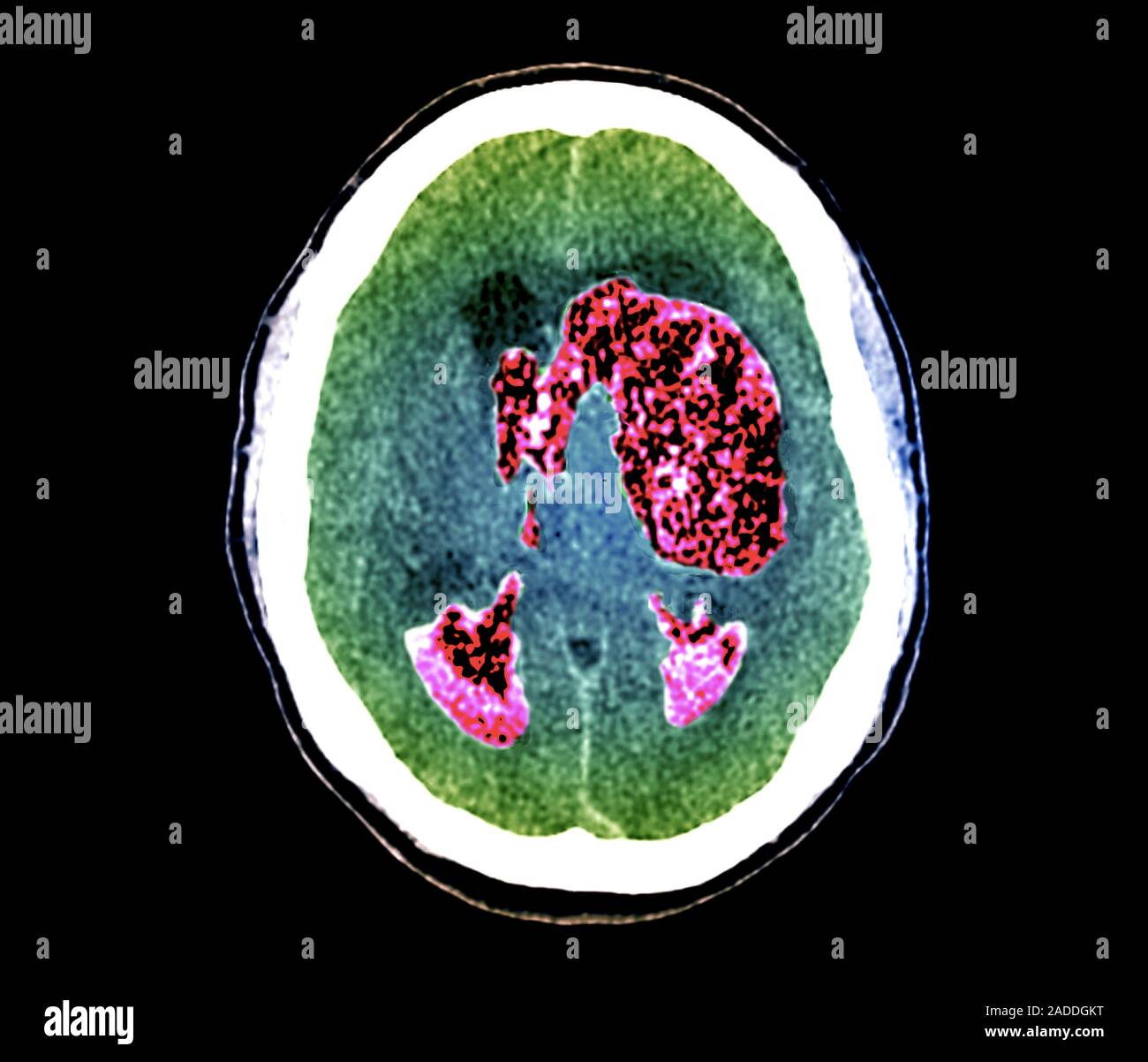 Stroke and intracerebral haemorrhage. Coloured axial computed tomography (CT) scan through the ...