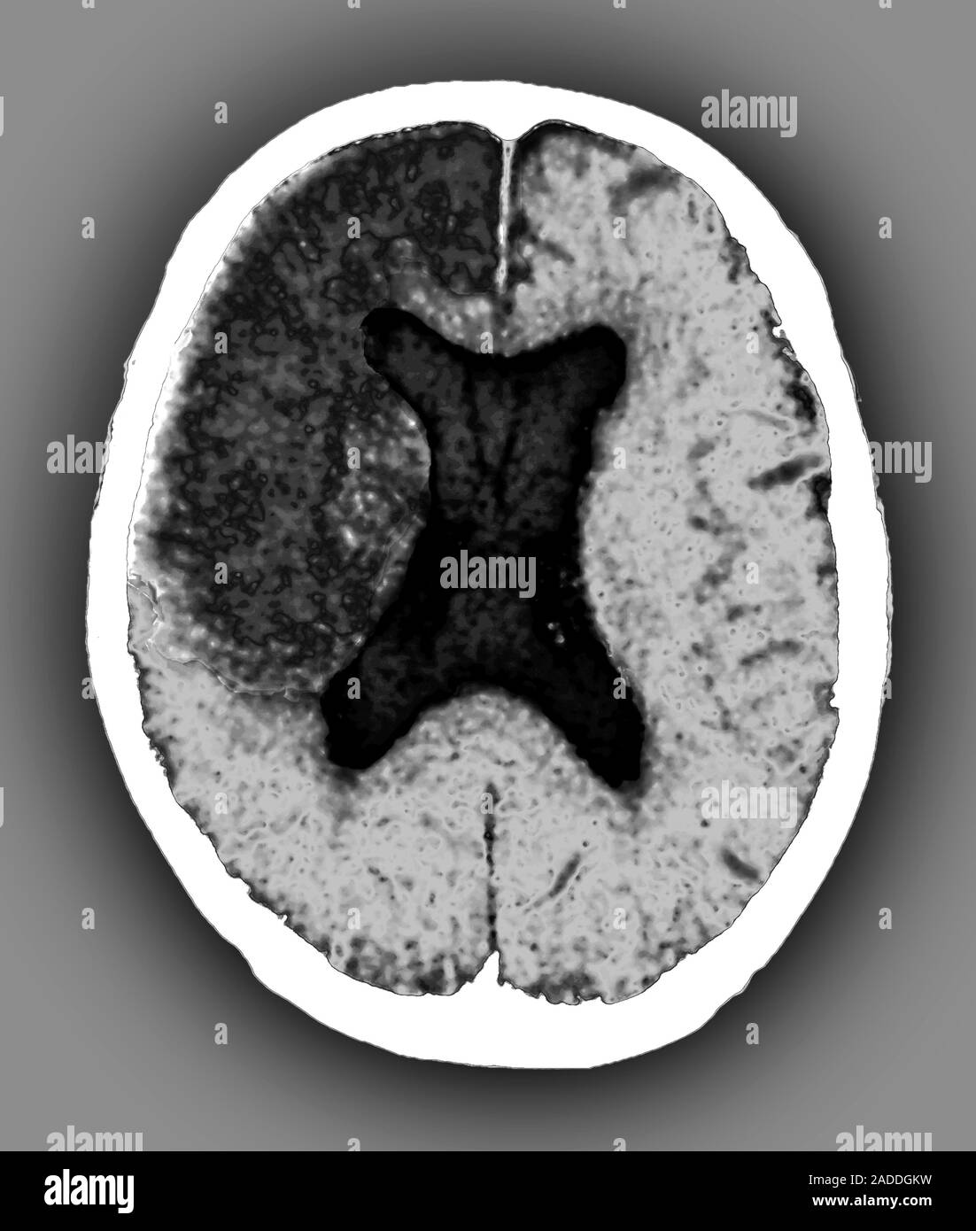 Cerebral infarction. Axial computed tomography (CT) scan through the ...