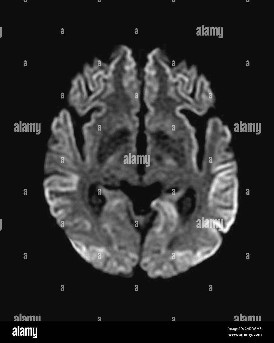 Creutzfeldt-Jakob disease. Axial magnetic resonance imaging (MRI) scan ...