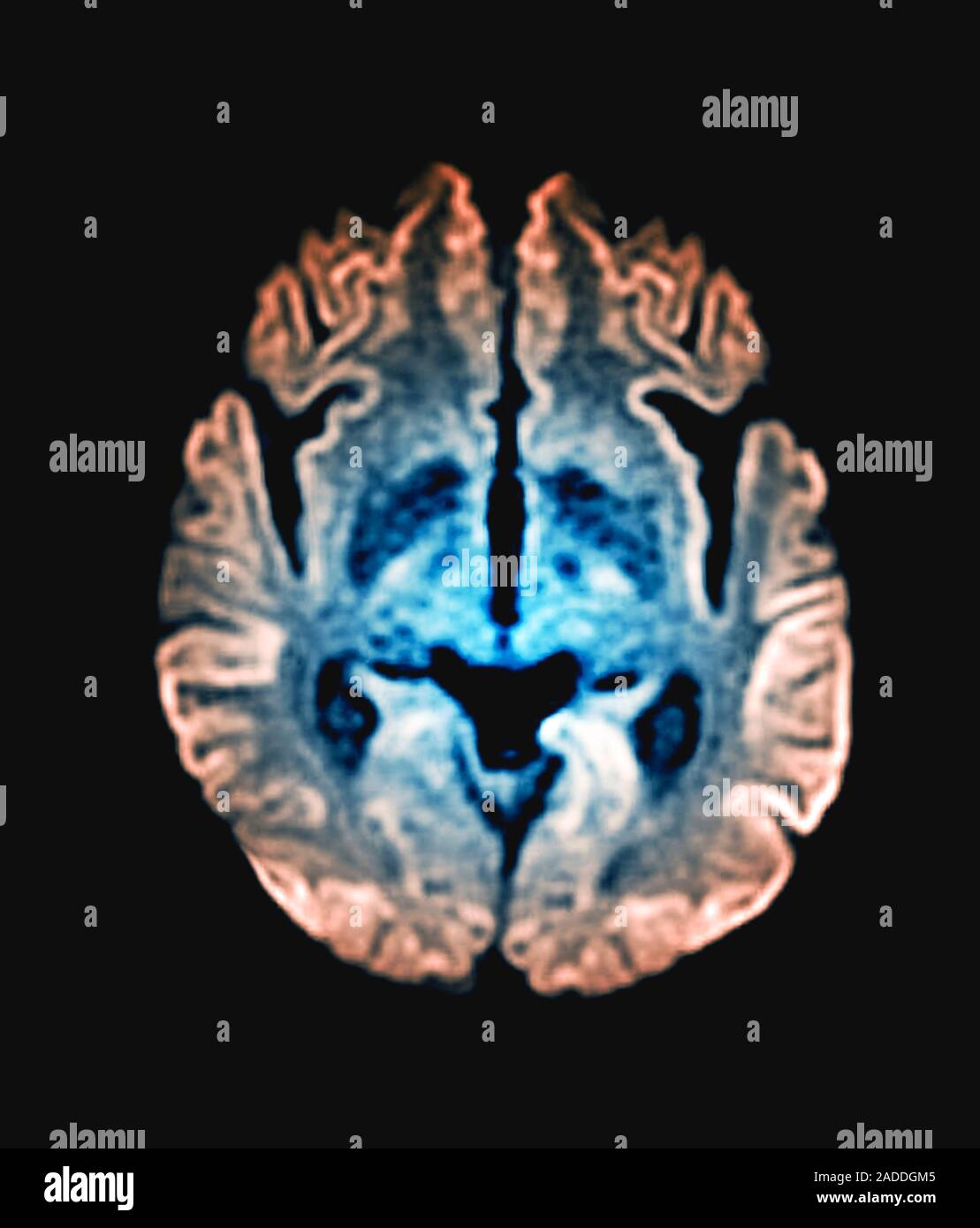 Creutzfeldt-Jakob disease. Coloured axial magnetic resonance imaging ...