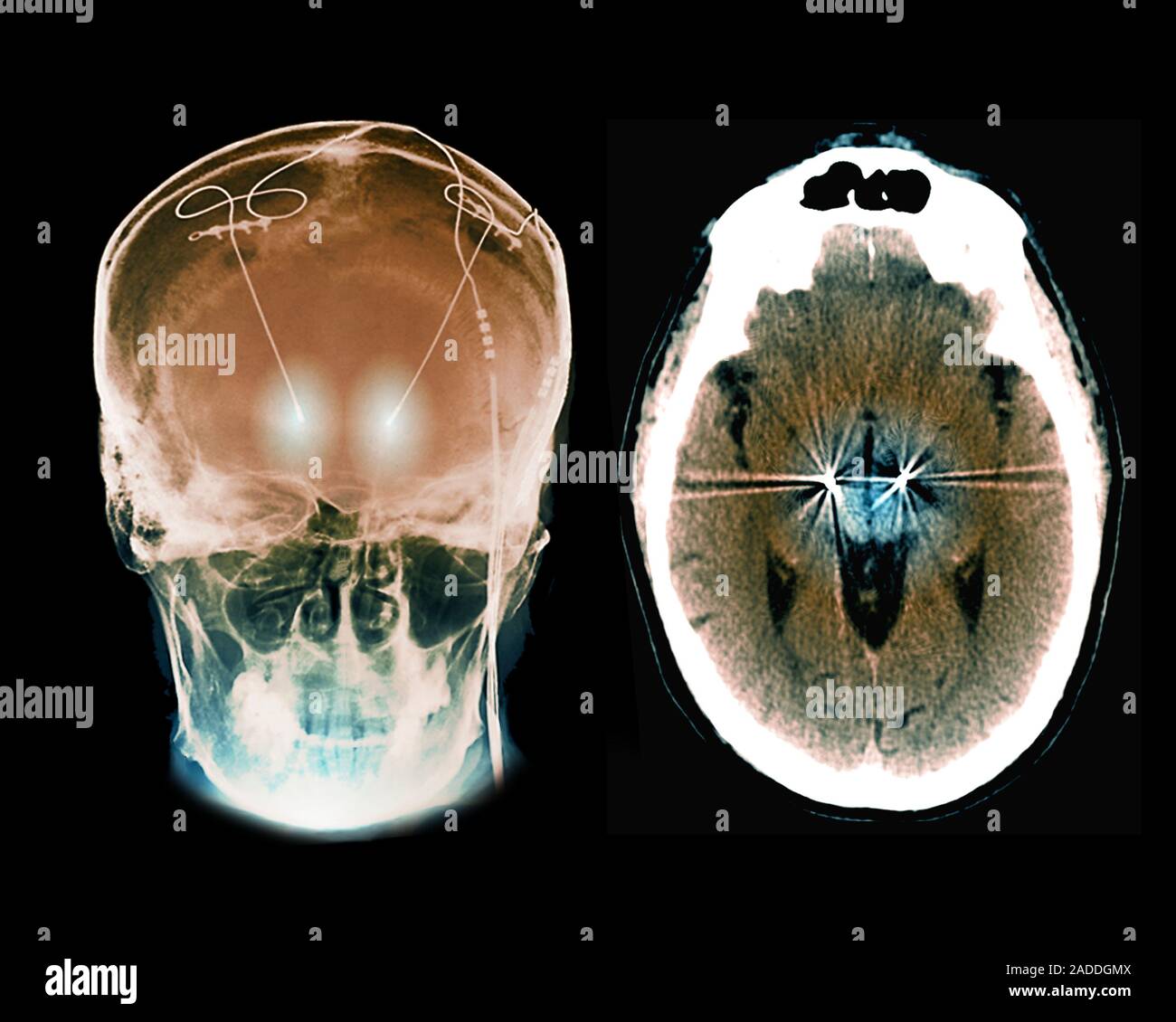 Parkinson's disease brain stimulation electrodes. Coloured frontal X ...