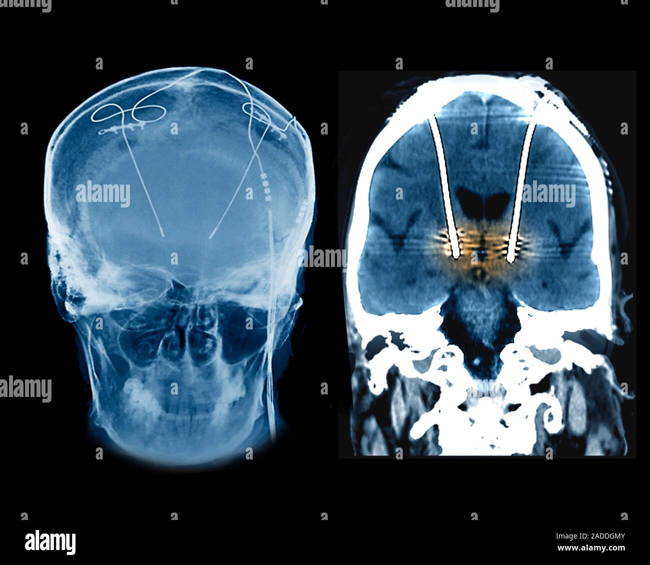 Parkinson's disease brain stimulation electrodes. Coloured frontal X ...