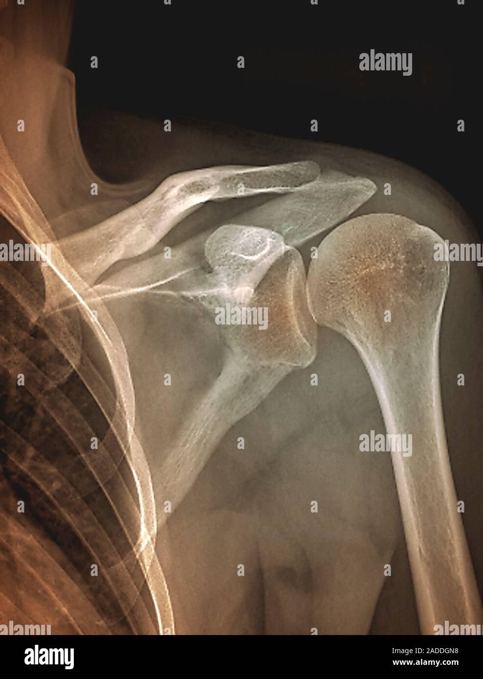 Shoulder joint. Coloured frontal X-ray of the normal left shoulder ...