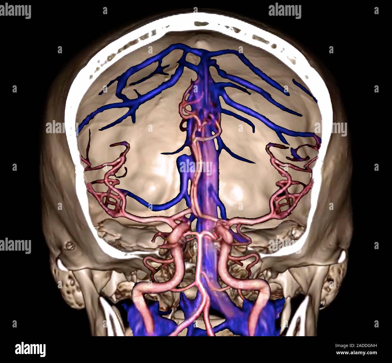 Brain arteries and venous sinuses. Coloured frontal 3D computed tomography (CT) angiogram ...