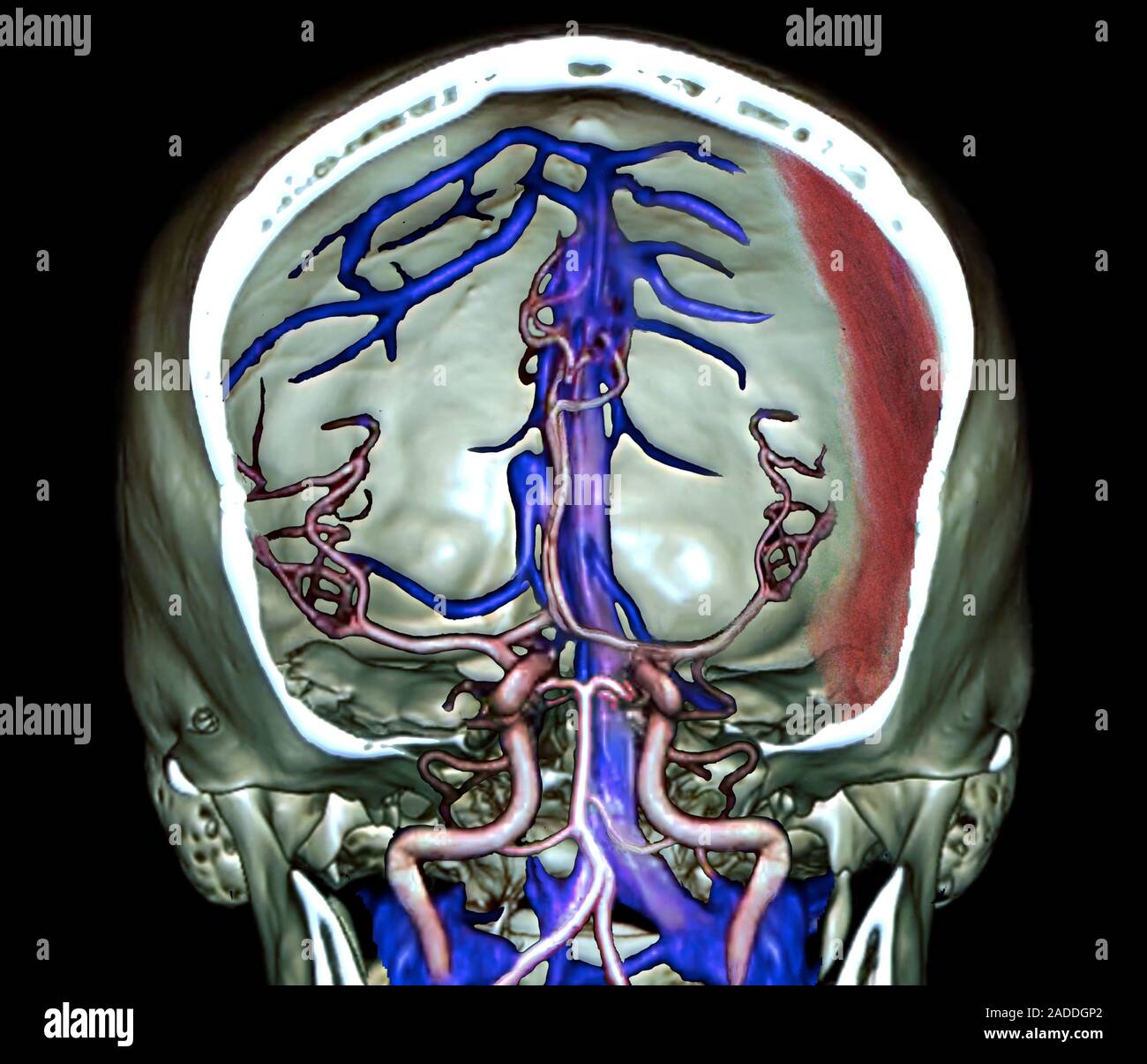 Subdural haematoma. Coloured frontal 3D computed tomography (CT ...