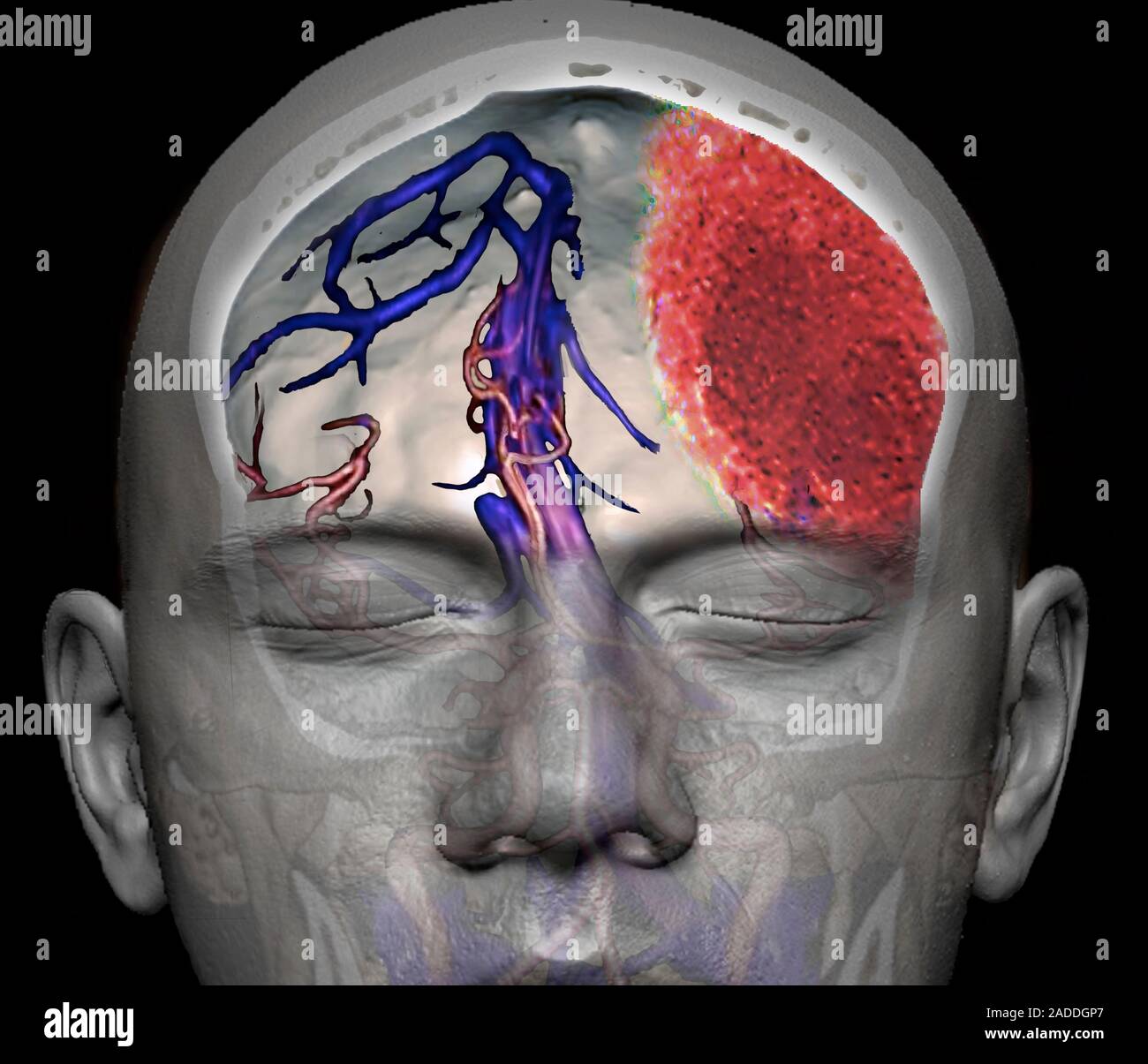 Extradural haematoma. Coloured frontal 3D computed tomography (CT ...