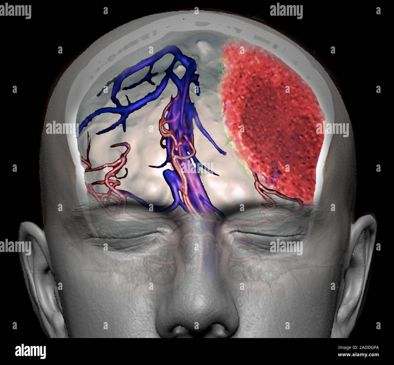Extradural haematoma. Coloured frontal 3D computed tomography (CT) angiogram, combined with a ...
