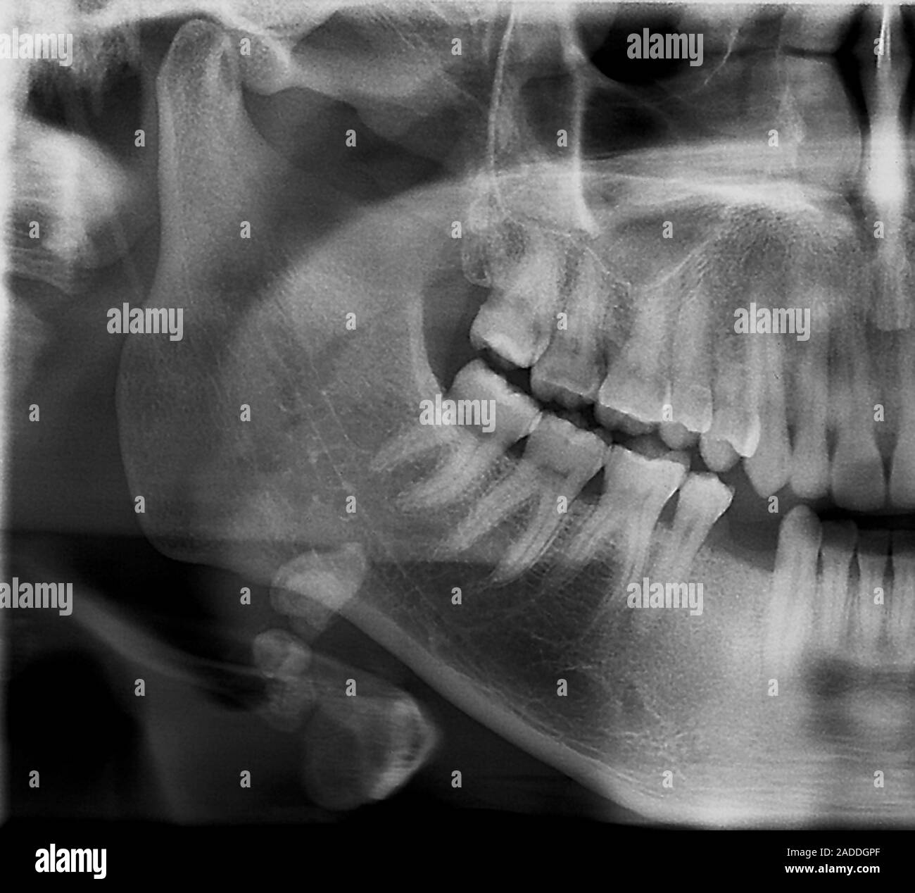 Salivary gland stones. X-ray of part of the mouth and lower jaw of a 36 ...