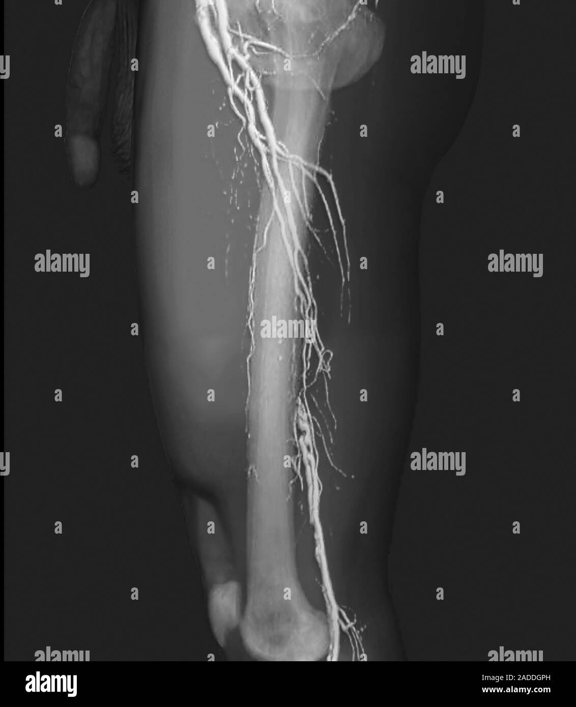 Nearly blocked femoral arteries. Lateral 3D computed tomography (CT ...