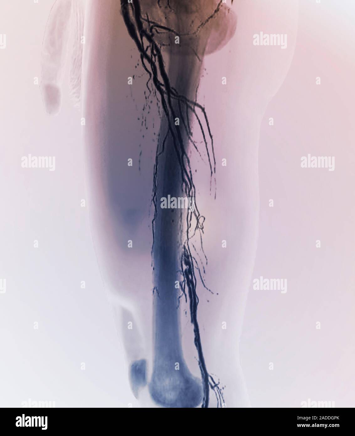 Nearly blocked femoral arteries. Coloured lateral 3D computed ...