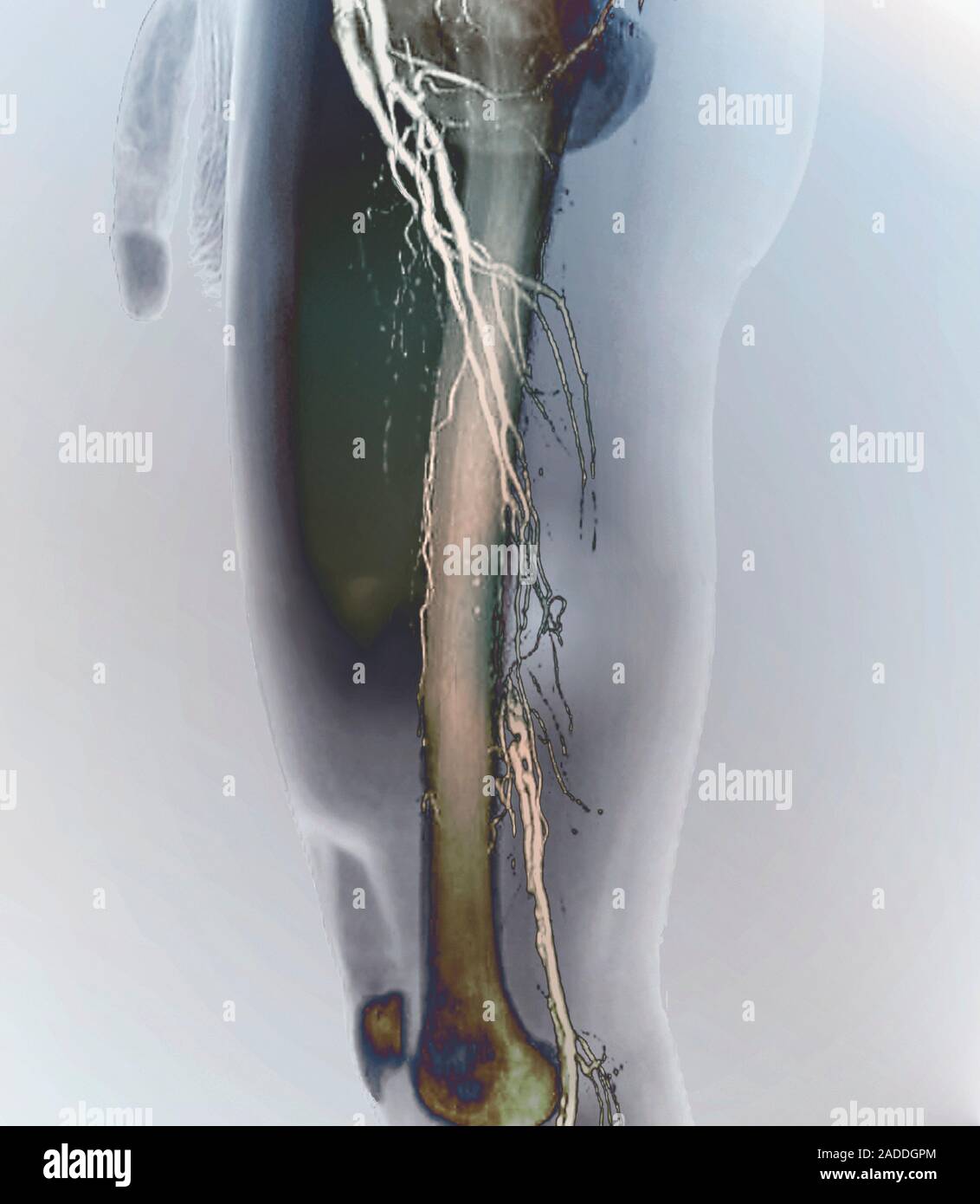 Nearly blocked femoral arteries. Coloured lateral 3D computed tomography (CT) angiogram (blood ...