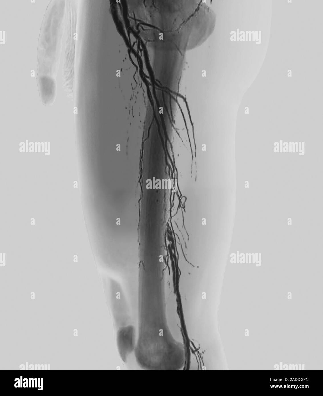 Nearly blocked femoral arteries. Lateral 3D computed tomography (CT) angiogram (blood vessel X ...