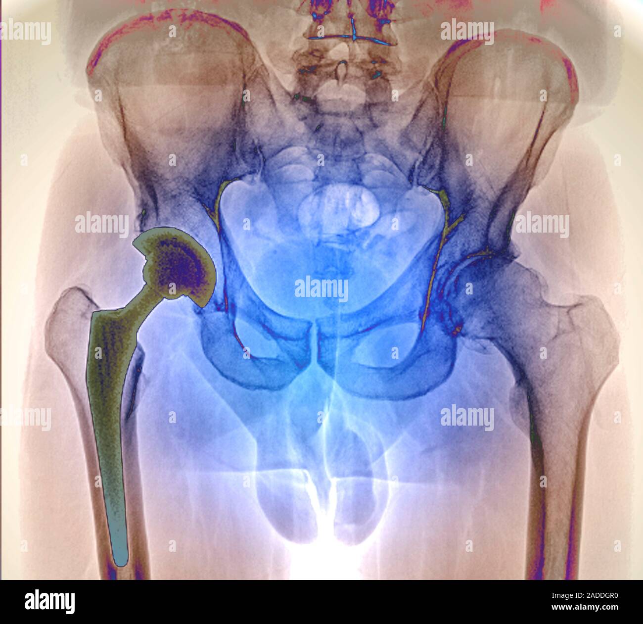 Total hip replacement. Coloured frontal X-ray of the pelvis of a 54 ...