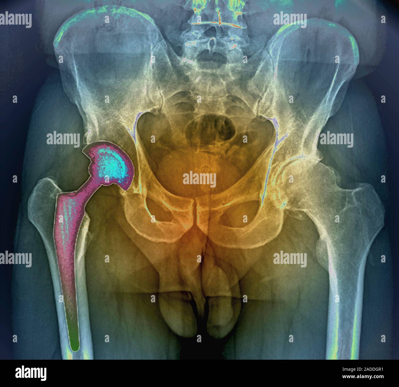 Total hip replacement. Coloured frontal X-ray of the pelvis of a 54 ...