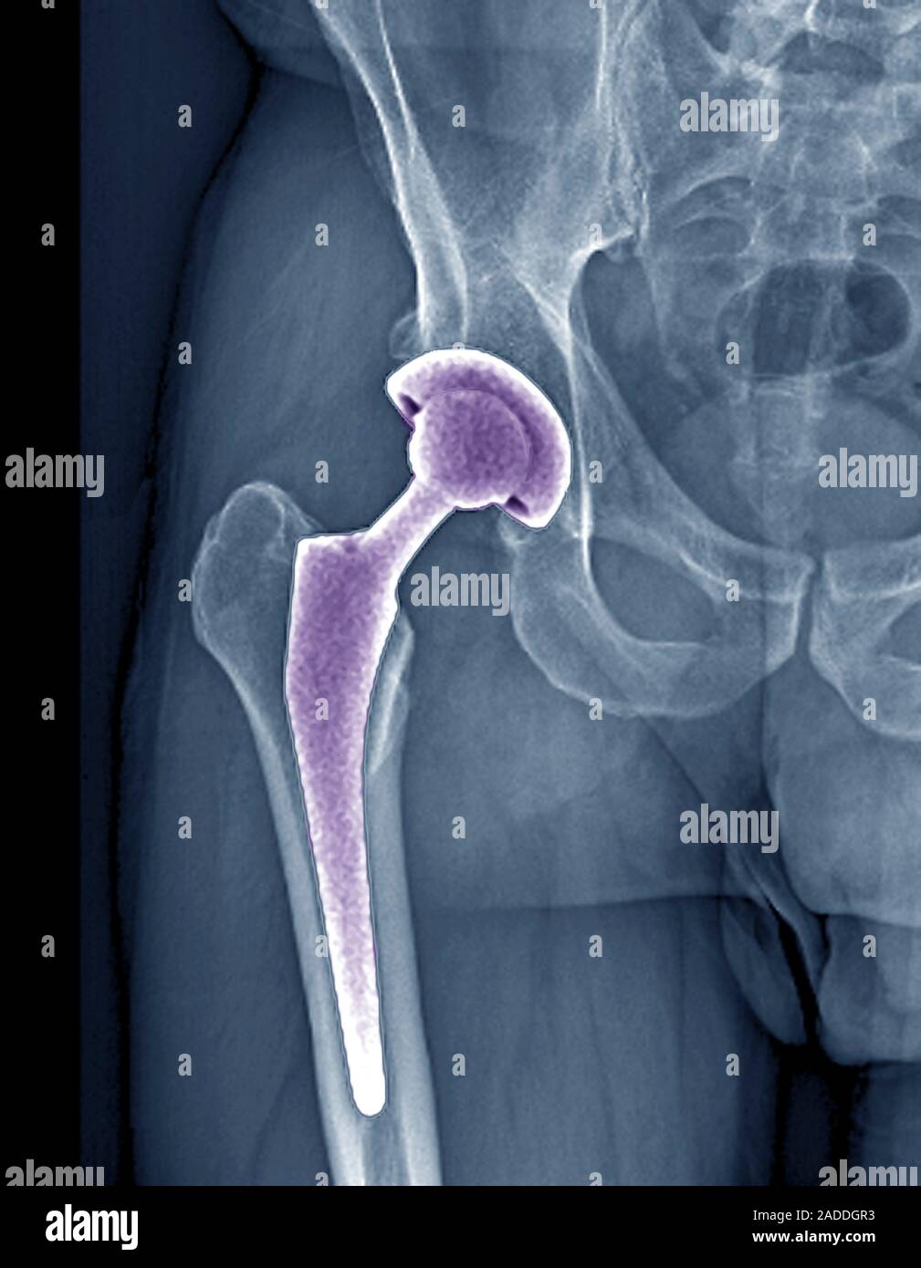 Right Total Hip Replacement X Ray Hip Replacement X Ray Hi Res Stock