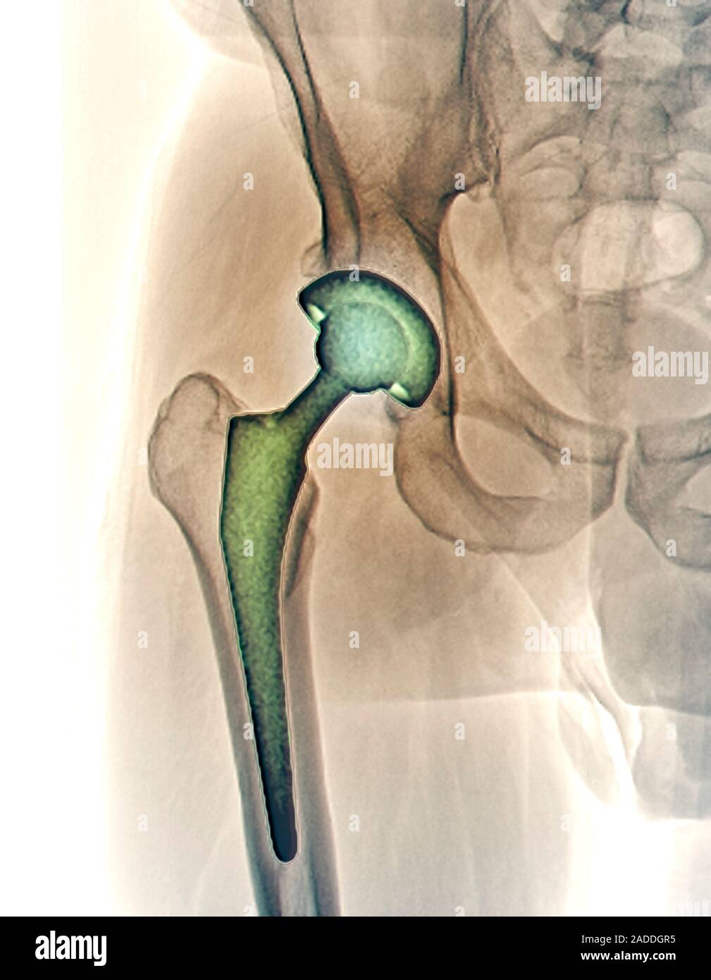 Total hip replacement. Coloured frontal X-ray of the right hip of a 54 ...