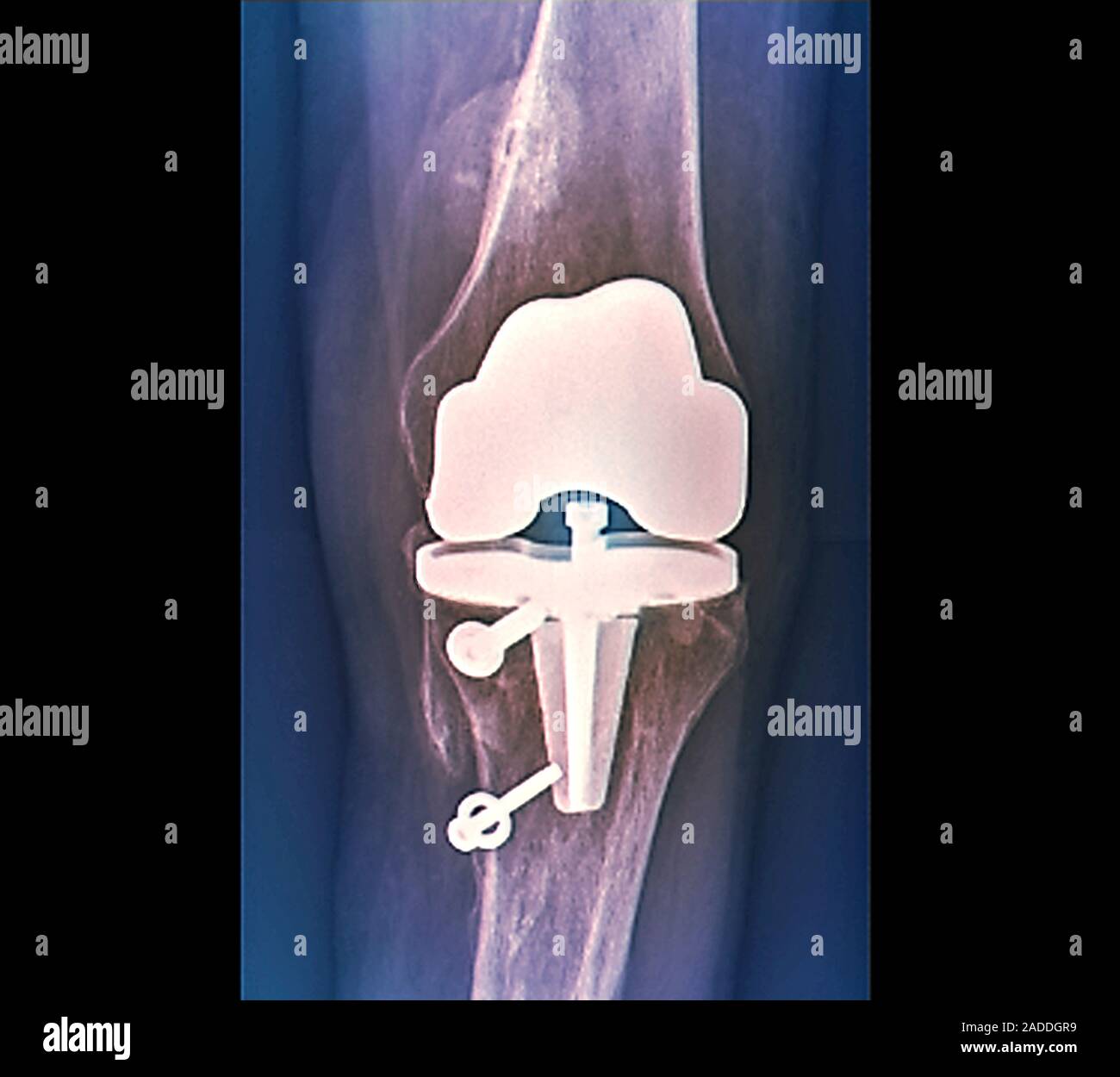 Total knee replacement. Coloured frontal X-ray of the components of a ...
