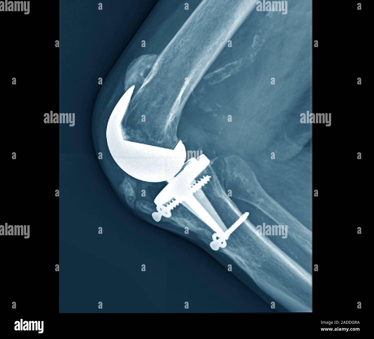 Total knee replacement. Lateral X-ray of the components of a prosthetic ...