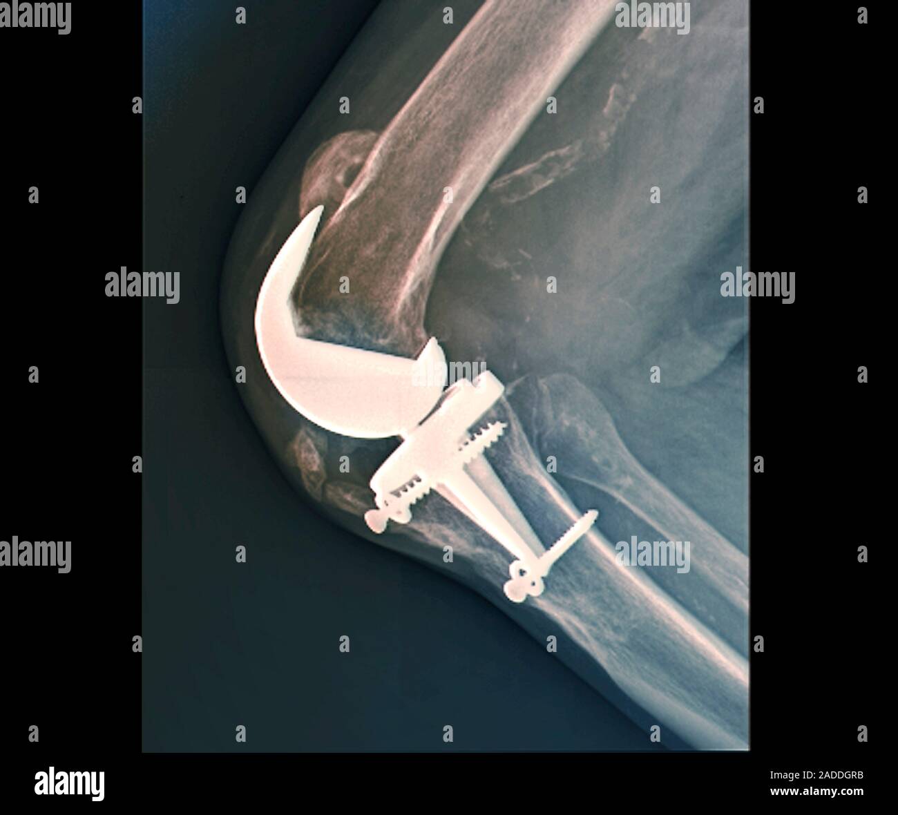 Total knee replacement. Coloured lateral X-ray of the components of a ...