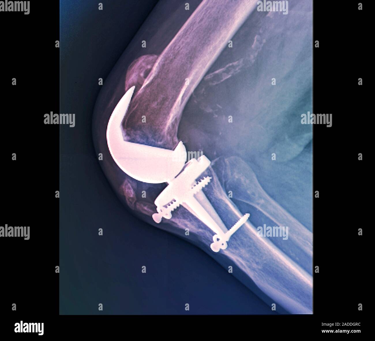 Total knee replacement. Coloured lateral X-ray of the components of a ...
