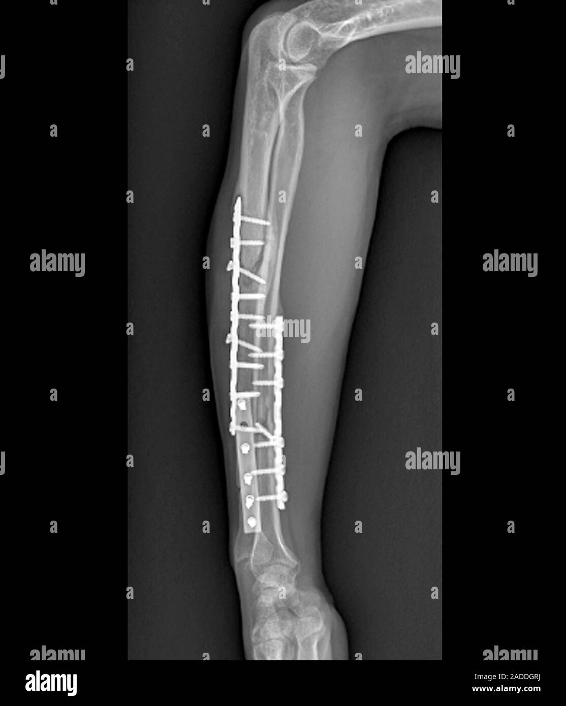 Pinned fractured lower arm bones. Lateral X-ray of screws and plates ...