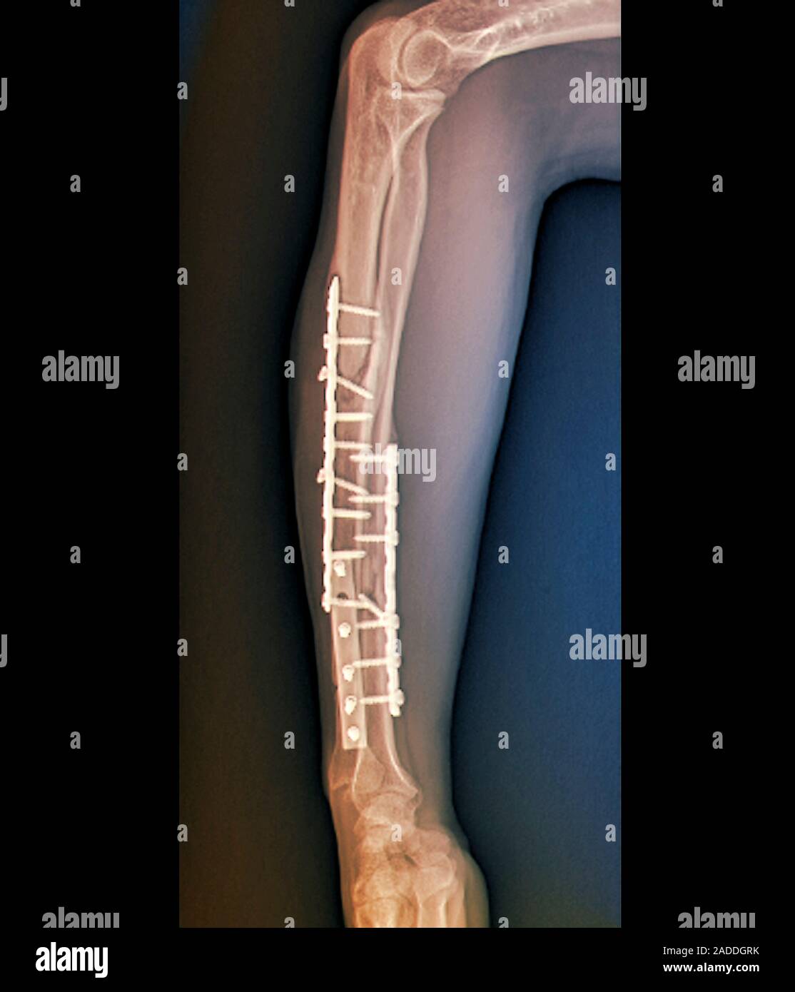 Pinned fractured lower arm bones. Coloured lateral X-ray of screws and ...
