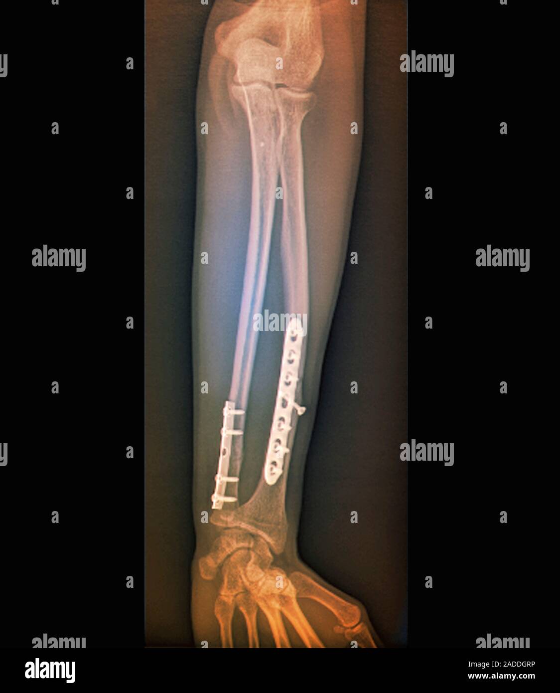 Pinned fractured lower arm bones. Coloured frontal X-ray of screws and ...